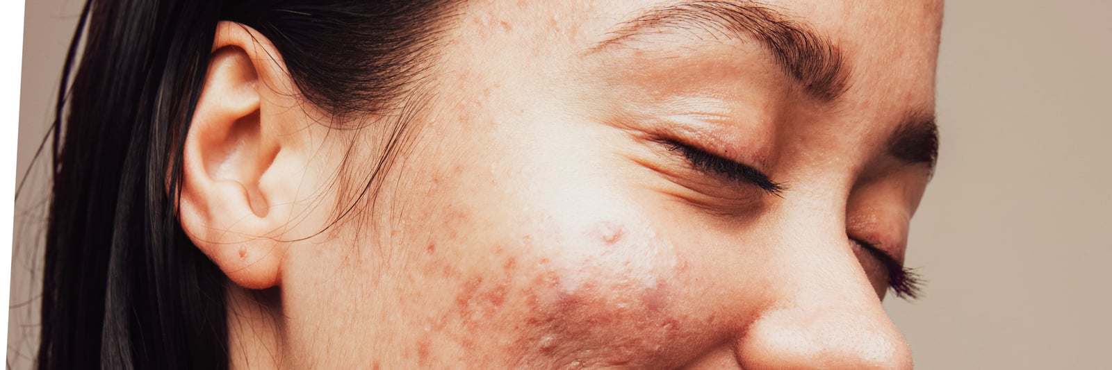 Akne - köp bra produkter mot akne online | Apohem